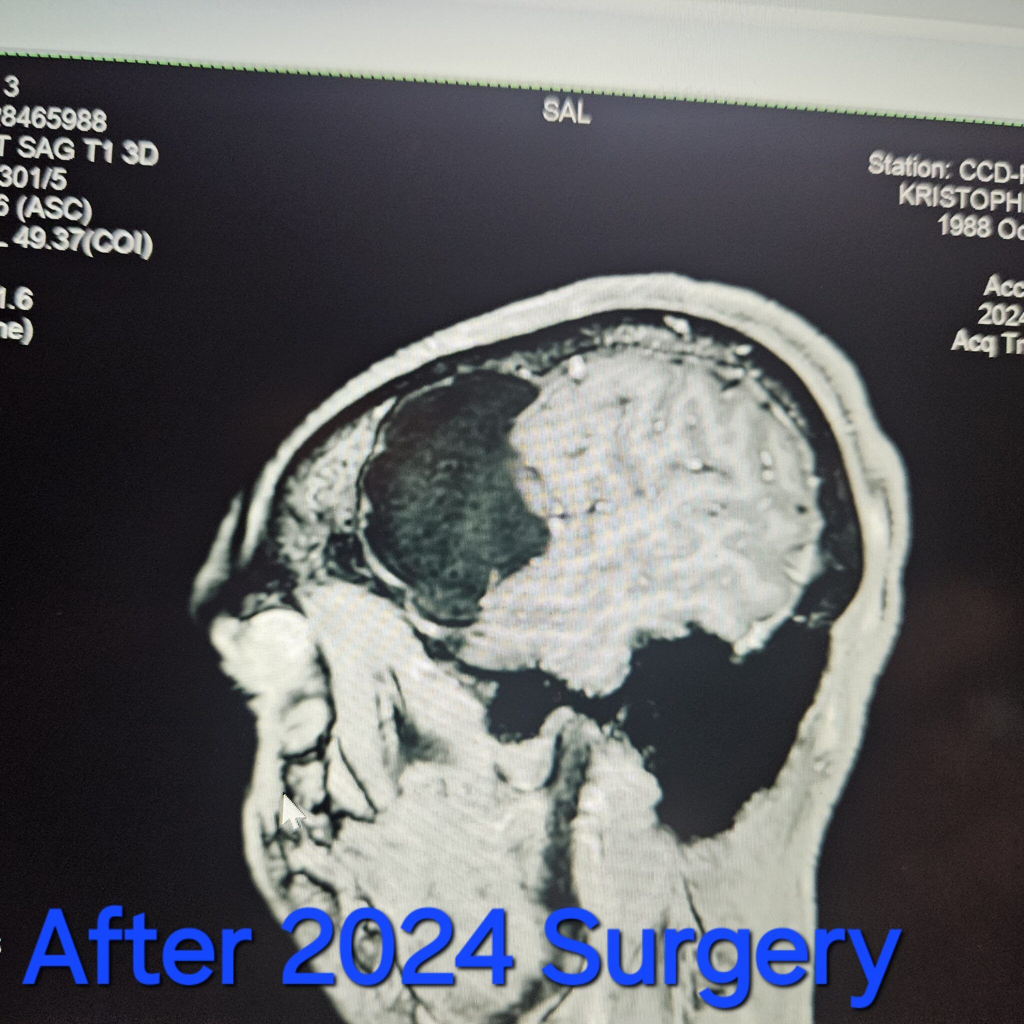 Understanding Kidney Cancer Brain Metastases - American Brain Tumor Association