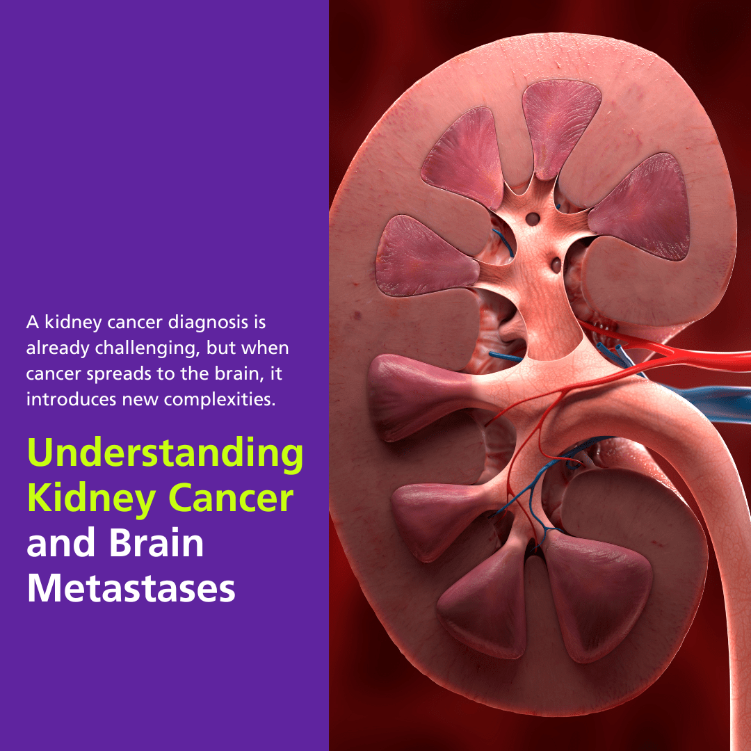 Understanding Kidney Cancer Brain Metastases - American Brain Tumor ...